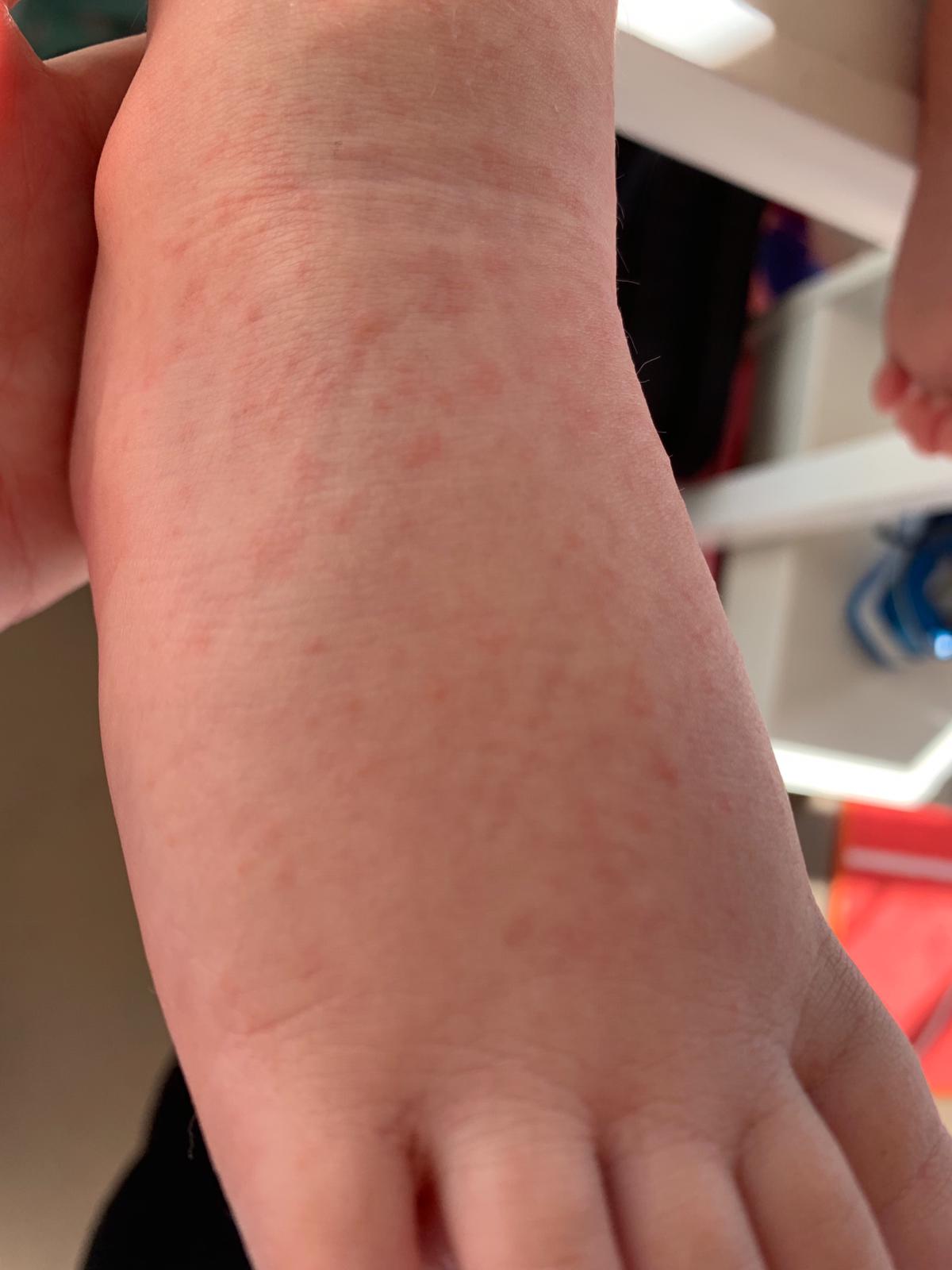 Foot And Mouth Disease In Children Foot And Mouth Disease In Children