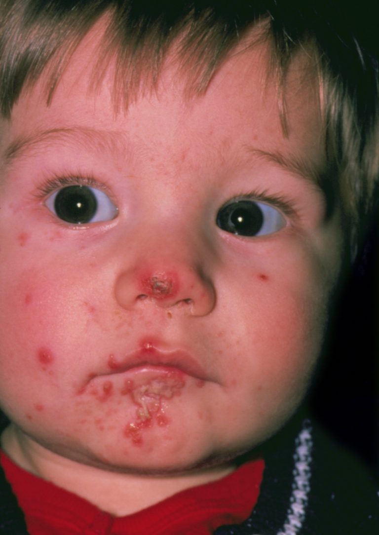 Impetigo - prevention, symptoms, and treatment of 'school sores'