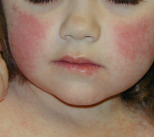 But why is it called 'Fifth disease'? Facts on 'slapped cheek' (Fifth ...